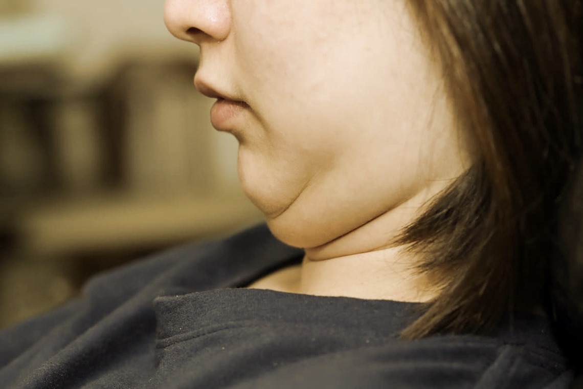 Chin Liposuction – Half Your Double Chin - Chin Liposcution