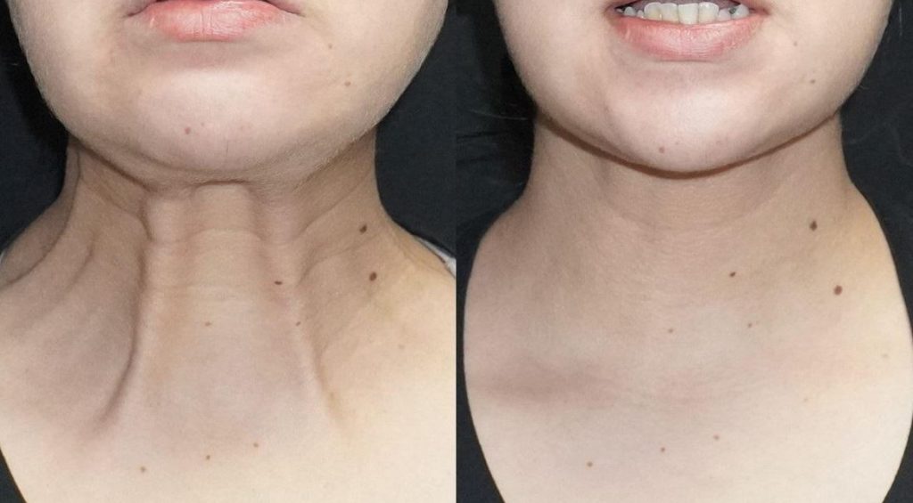Neck Botox Before and After: Enhancing Your Neck's Appearance - Chin ...